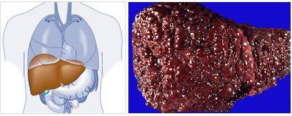 VIDEO medTECH Fibroza hepatica din bolile hepatice cronice si ...